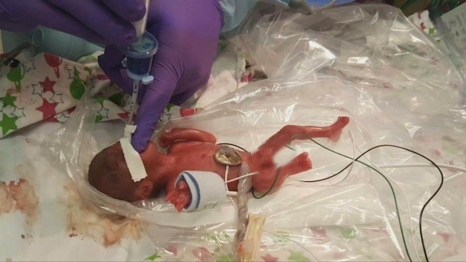 Saybie, believed to be world's tiniest baby ever to survive, goes home ...